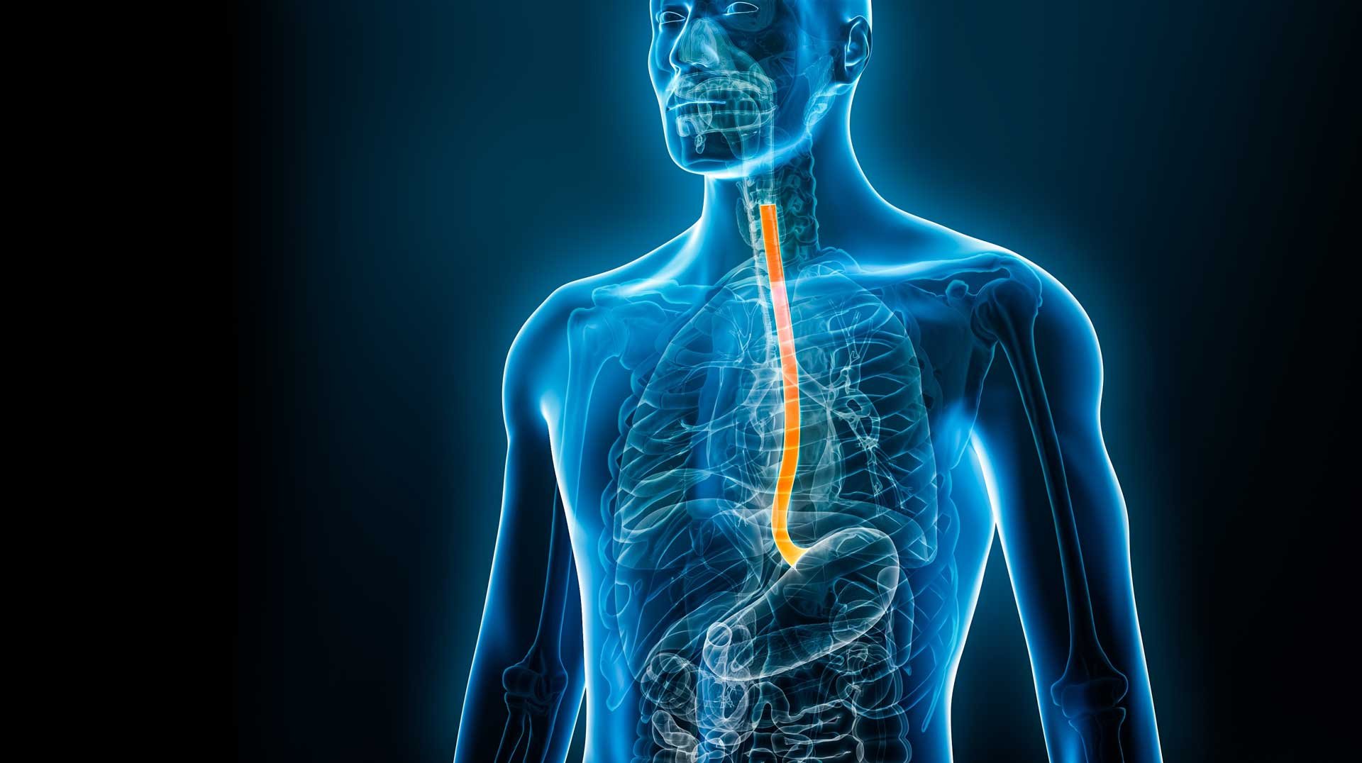 Dysphagia Overview: Symptoms, Diagnosis, & Treatments | IFAR