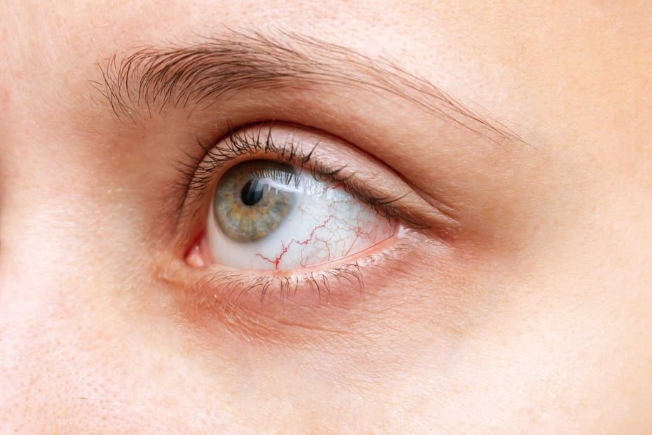 Spotting the Signs: How to Recognize Neurotrophic Keratitis Symptoms
