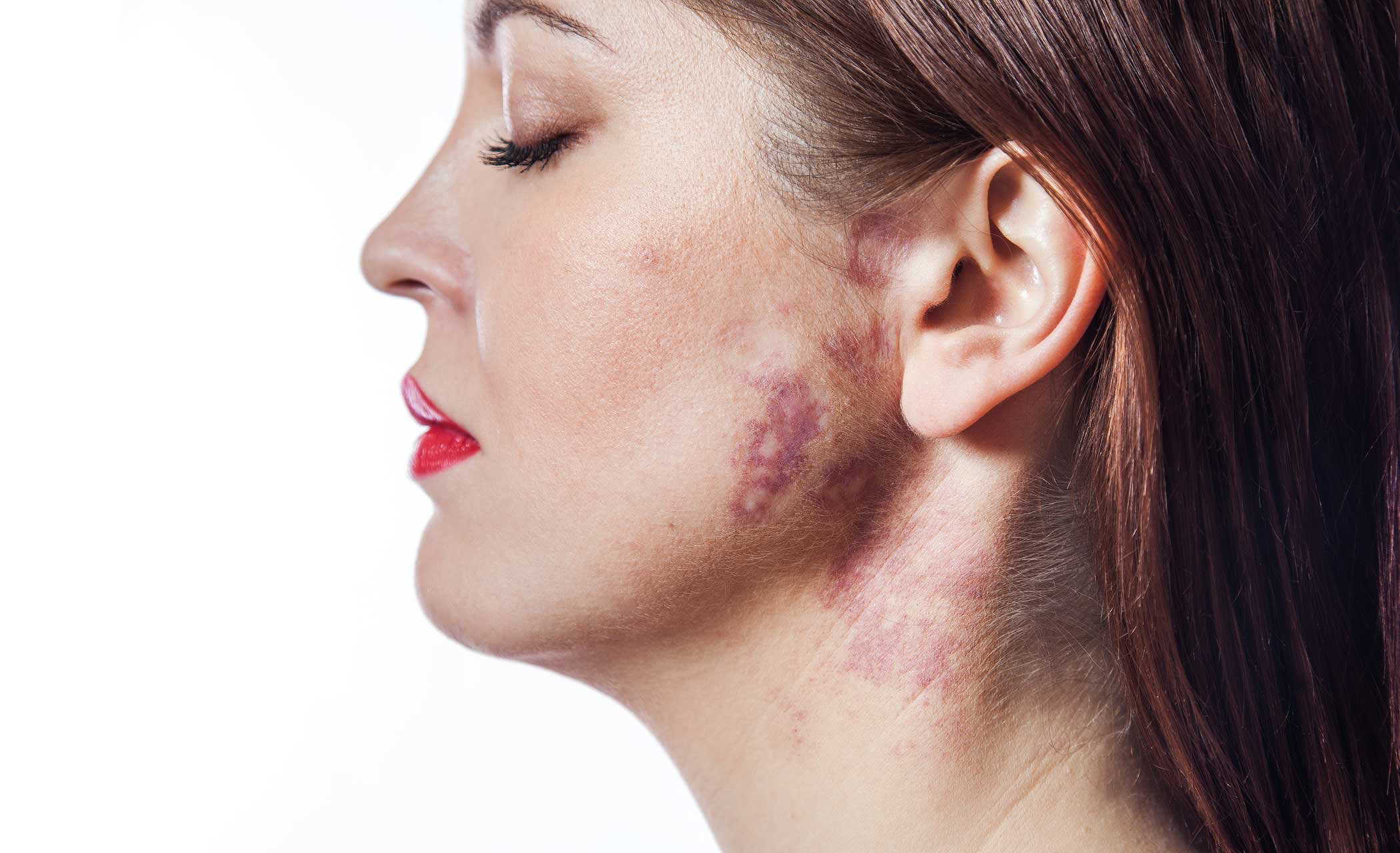 Capillary Malformation: Symptoms, Diagnosis, & Treatments | IFAR