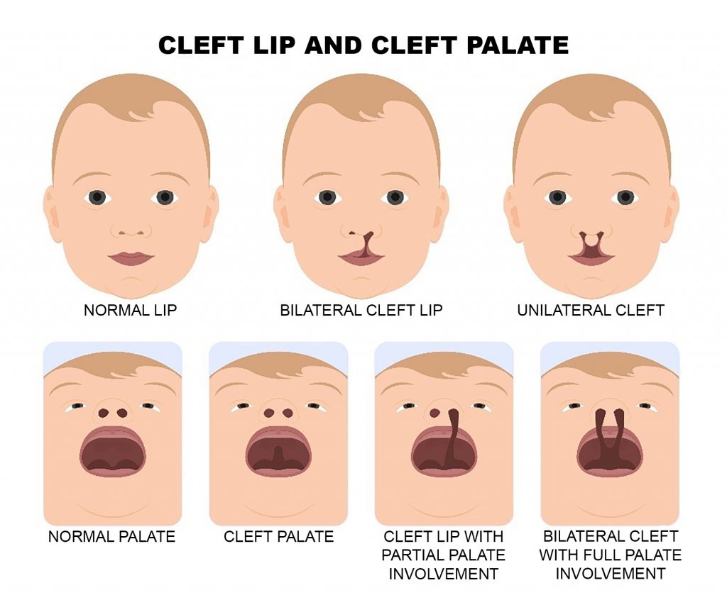 Cleft and Craniofacial Awareness Month